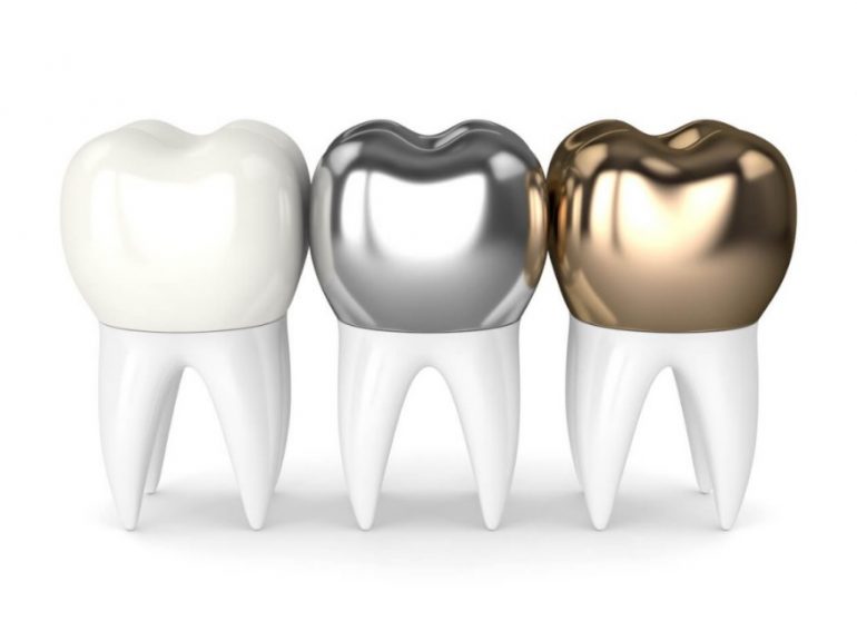 Tooth Crown | Dental Crowns Sydney | Sydney CBD Dentistry